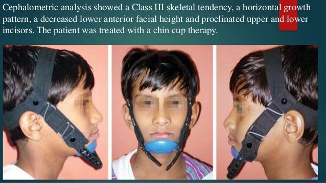 Chin cup for treatment of growing class III patient