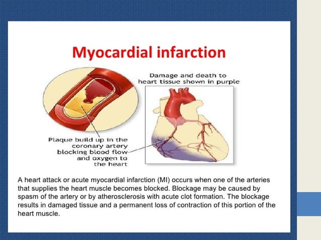 Myocardial Infarction Pathogenesis and Treatment | PPT | Heart and ...