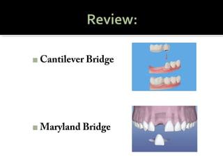 Materials for Inlays, Onlays, Crowns and Bridges | PPT