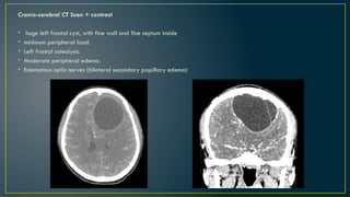 Chist hidatic cerebral - engleza.pptx123 | PPT