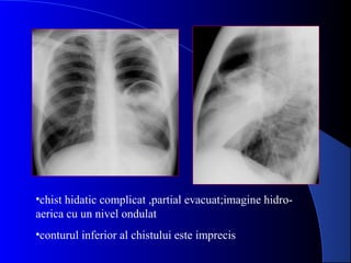 Chistul hidatic pulmonar | PPT