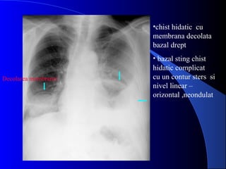 Chistul hidatic pulmonar | PPT