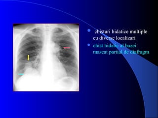 Chistul hidatic pulmonar | PPT