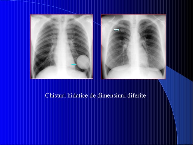 Chistul hidatic pulmonar