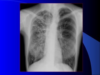 Chisturi pulmonare | PPT