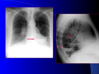 Chisturi pulmonare | PPT