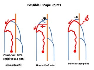 Differences between CHIVA strategy and ASVAL treatment. | PPT