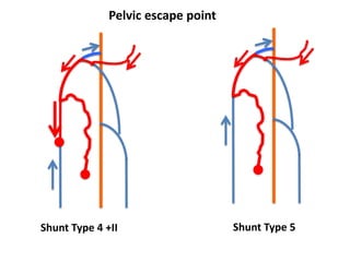 Differences between CHIVA strategy and ASVAL treatment. | PPTX