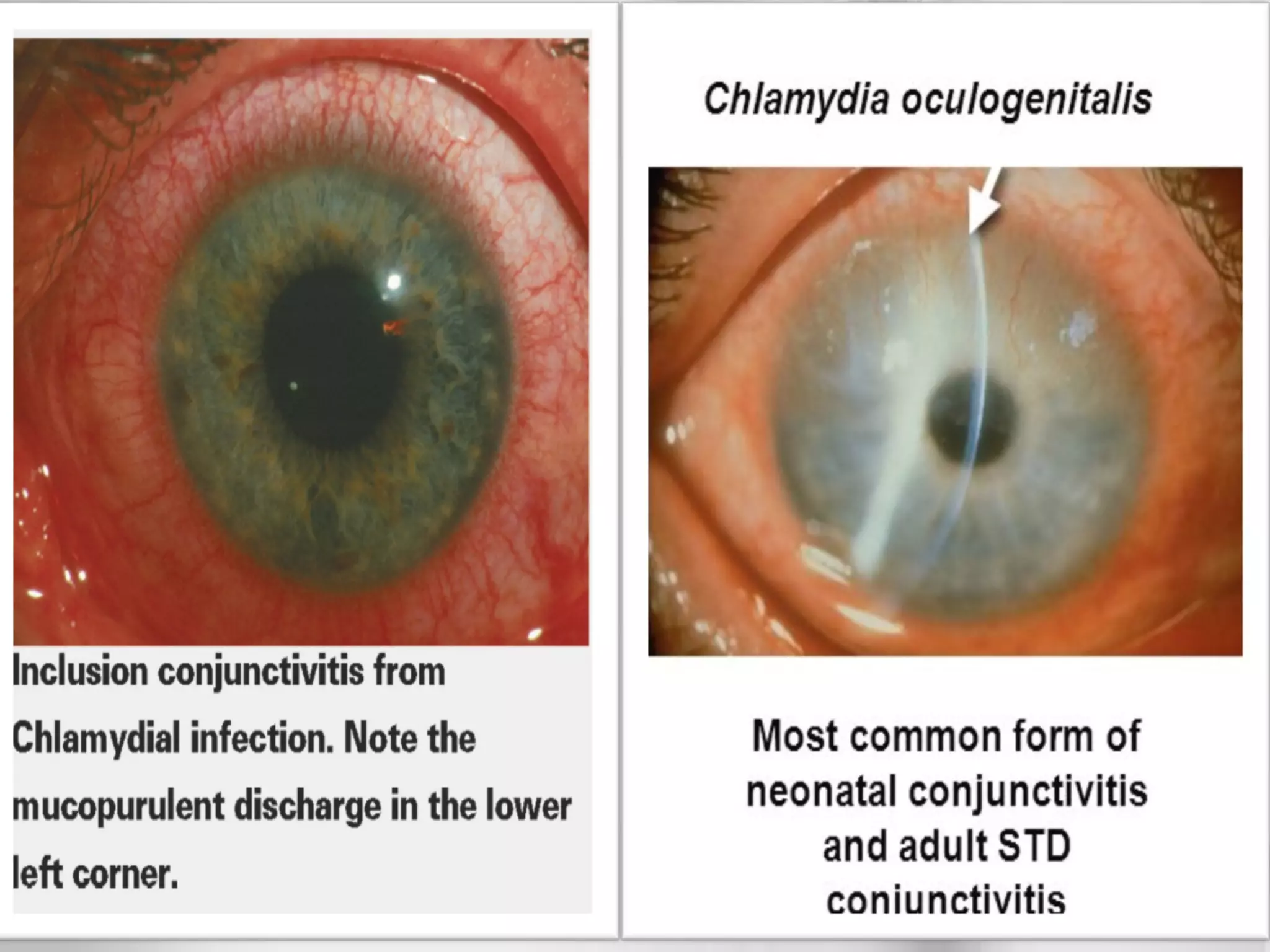 Chlamydia Conjunctivitis | PPT