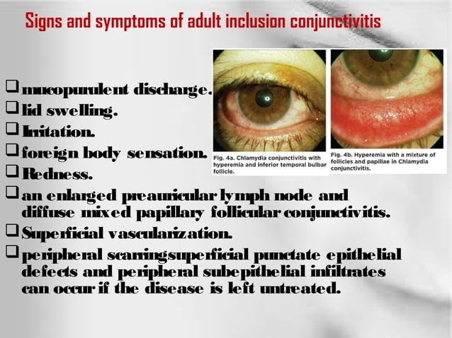 Chlamydia Conjunctivitis
