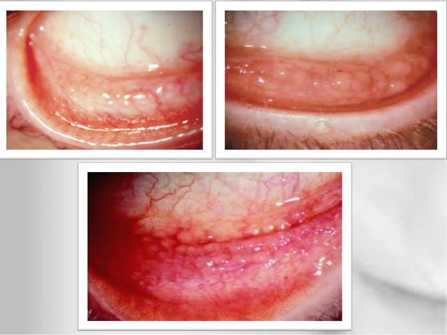 Chlamydia Conjunctivitis