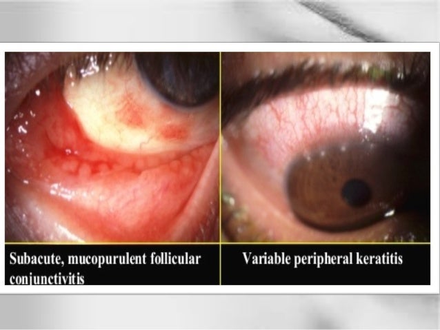 Chlamydia Conjunctivitis