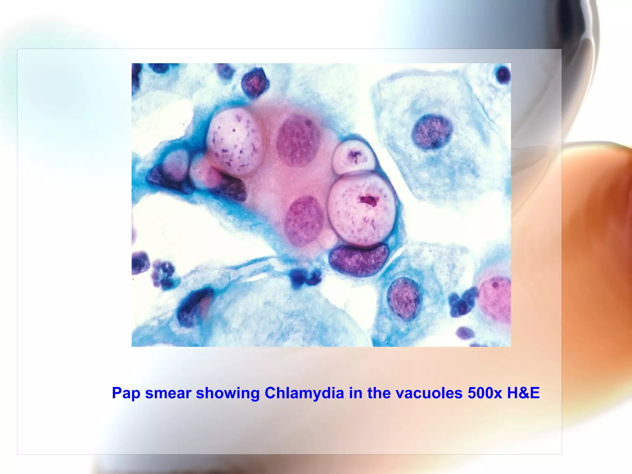 Chlamydia | PPT