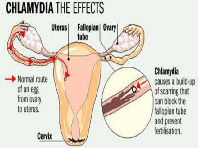 Chlamydia | PPT