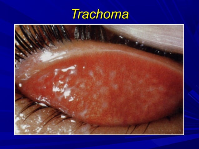 Chlamydia | PPT | Infectious Diseases | Diseases and Conditions