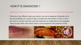 Chlamydia | PPT