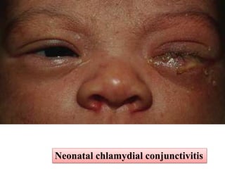 Chlamydia | PPTX