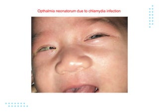 Chlamydia Edited.pptx , Chlamydia trachomatis | PPTX