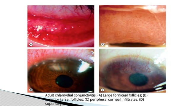 chlamydial conjunctivitis............pptx