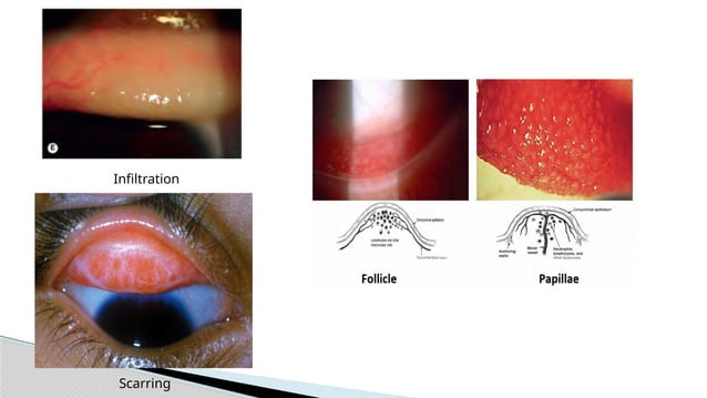 chlamydial conjunctivitis............pptx