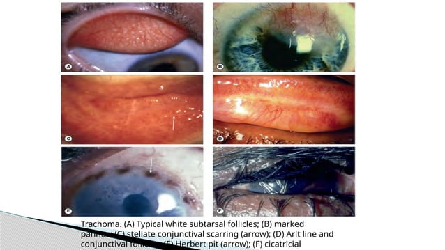 Chlamydial Conjunctivitis Pptx