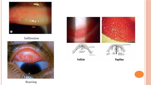 chlamydial ...........conjunctivitis.pptx