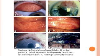 chlamydial ...........conjunctivitis.pptx