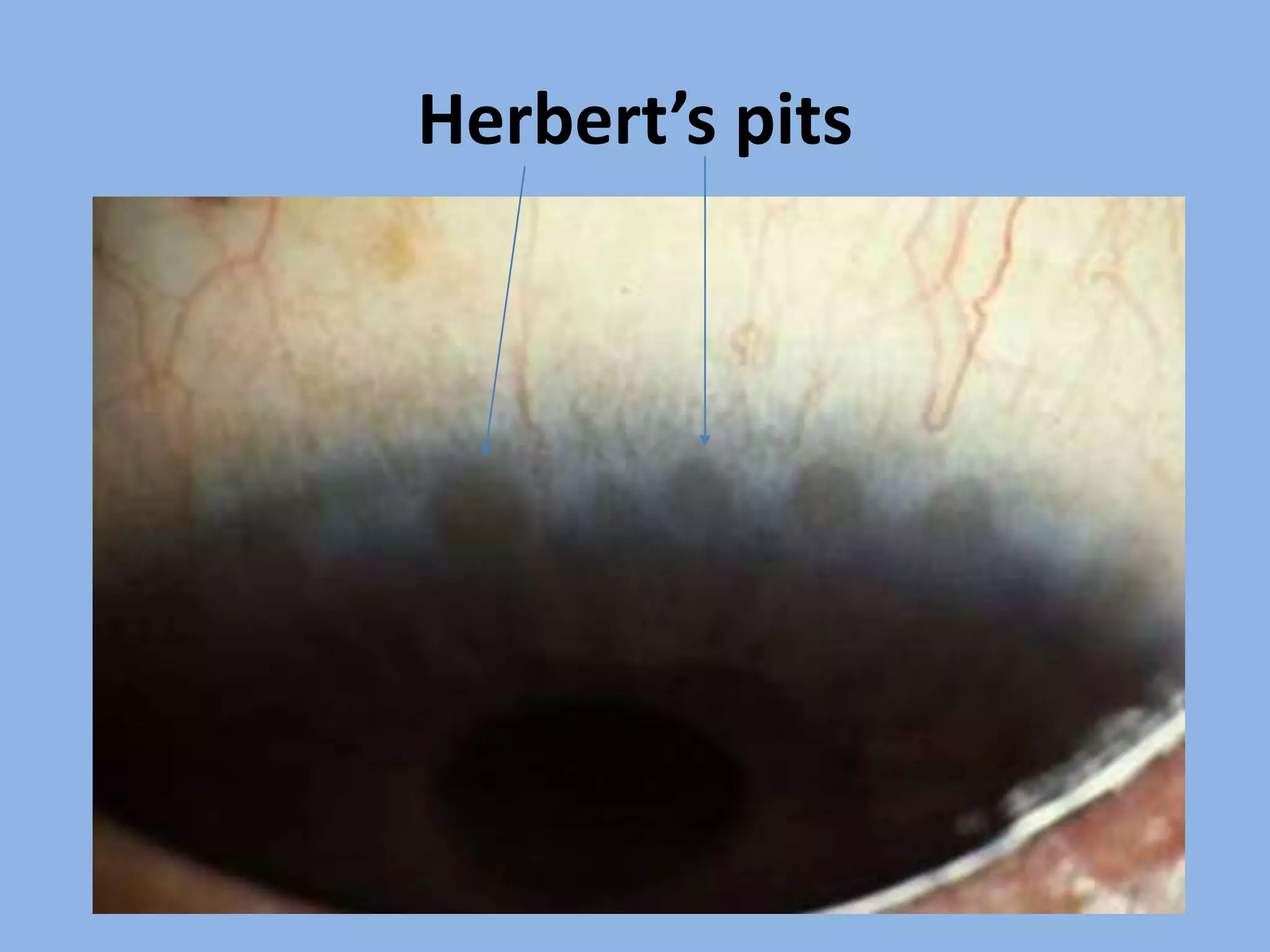 Chlamydial infections & ophthalmia neonatorum | PPTX