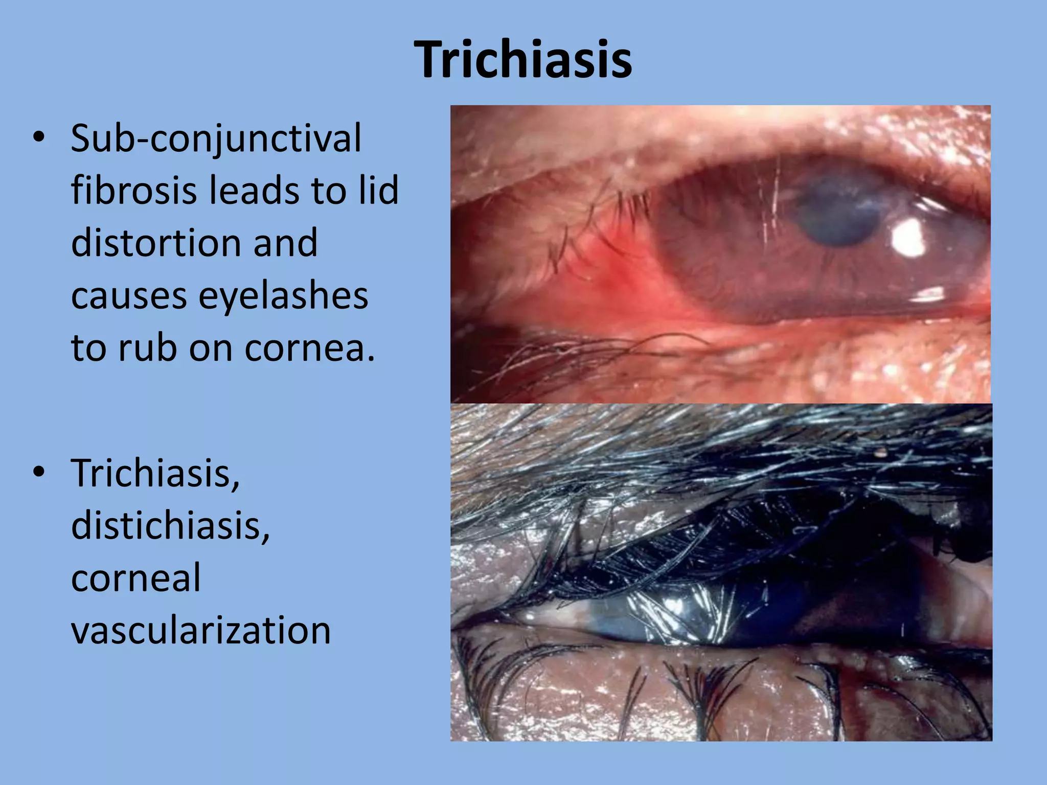 Chlamydial infections & ophthalmia neonatorum | PPTX