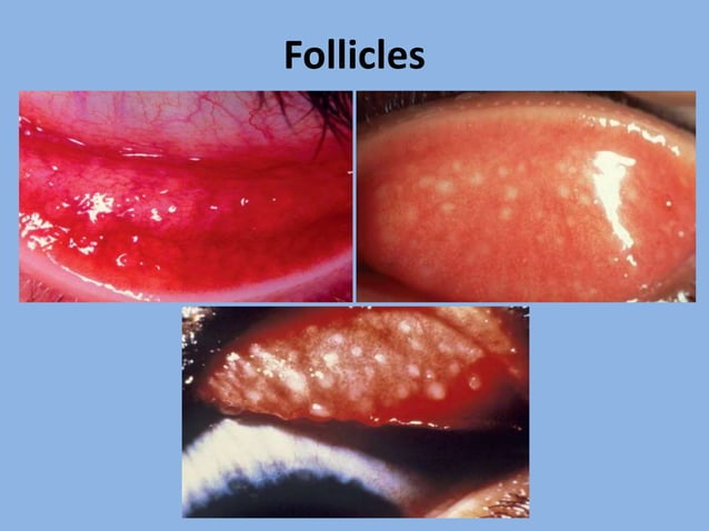 Chlamydial infections & ophthalmia neonatorum | PPTX | Eye and Vision ...