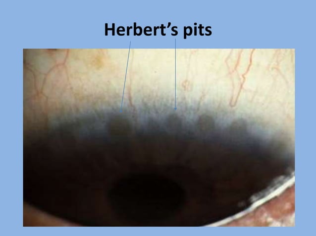 Chlamydial infections & ophthalmia neonatorum | PPTX | Eye and Vision ...