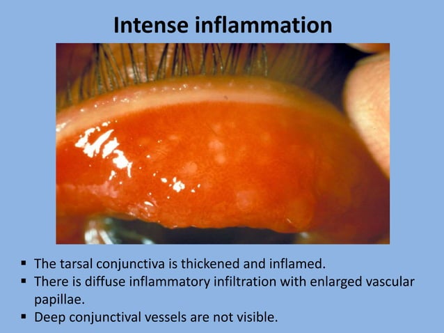 Chlamydial infections & ophthalmia neonatorum | PPTX | Eye and Vision ...