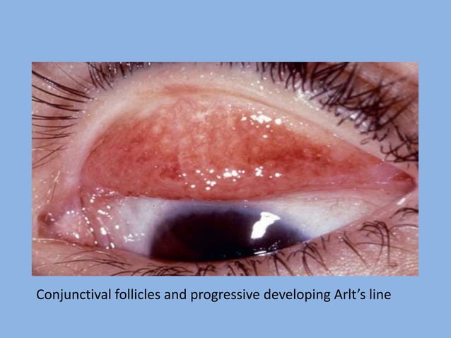 Chlamydial infections & ophthalmia neonatorum | PPTX | Eye and Vision ...