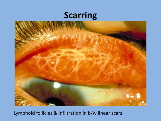Chlamydial infections & ophthalmia neonatorum | PPTX | Eye and Vision ...