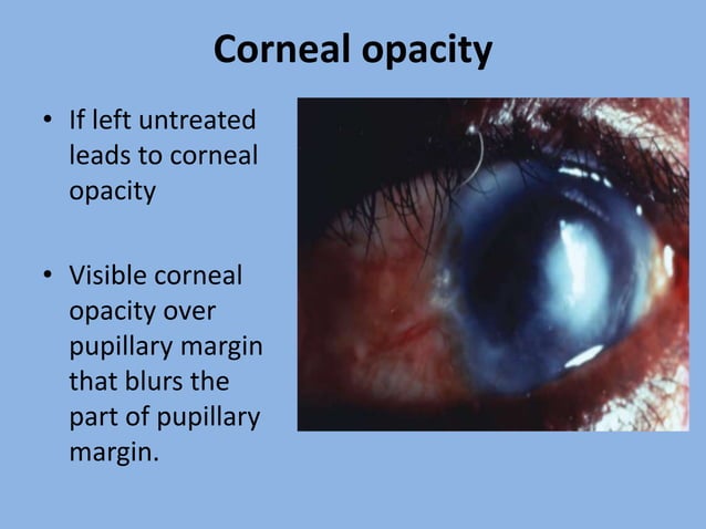 Chlamydial infections & ophthalmia neonatorum | PPTX | Eye and Vision ...