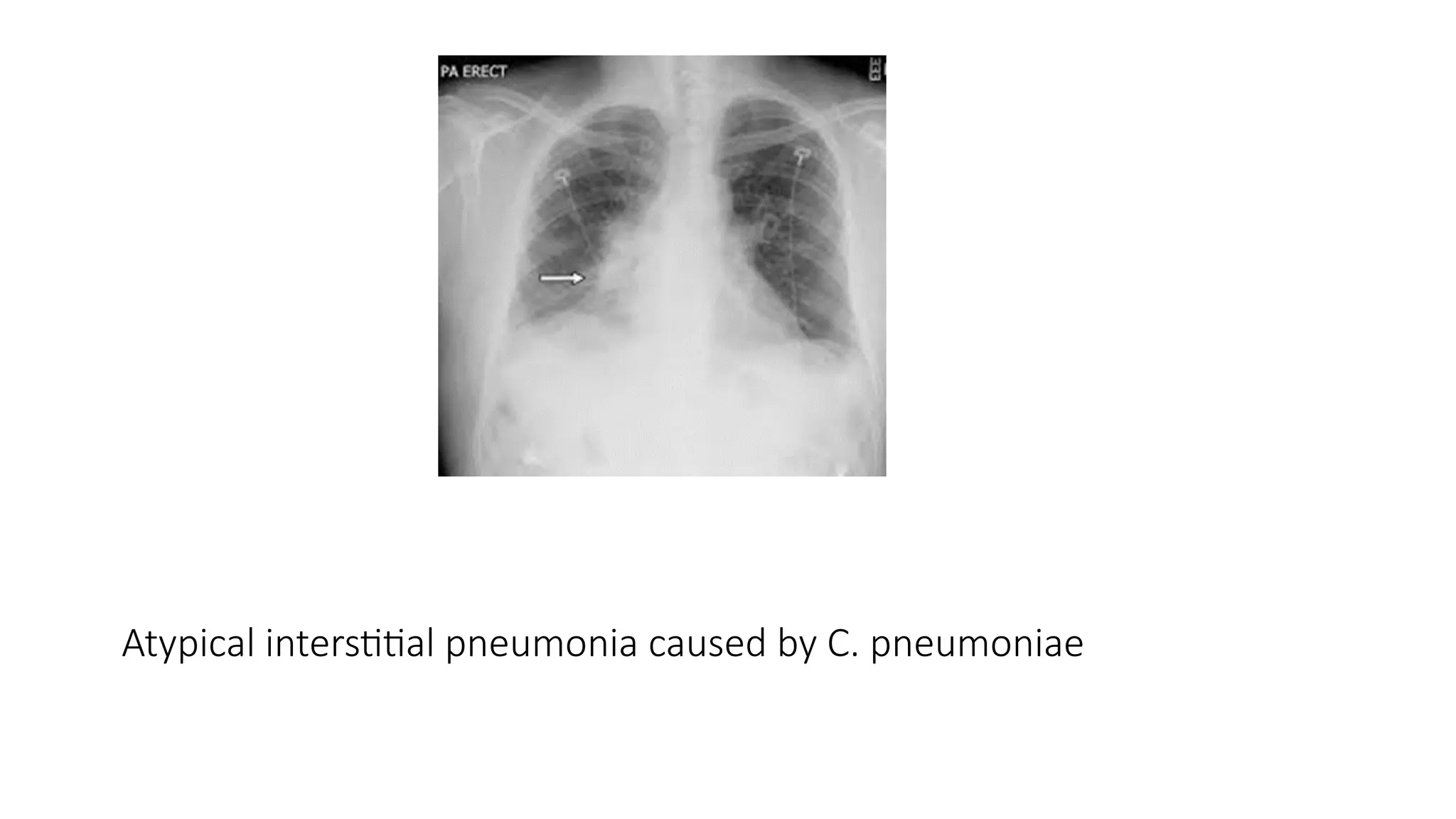 Chlamydia pneumonia- etiology, pathogenesis, clinical features, lab ...
