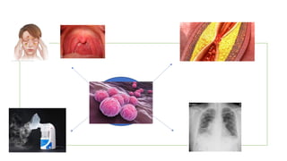 Chlamydia pneumonia- etiology, pathogenesis, clinical features, lab ...