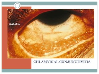 CHLAMYDIAL CONJUNCTIVITIS CAUSES AND TREATMENT | PPT