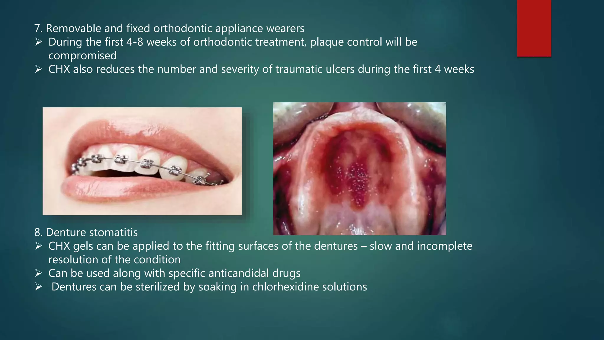 Chlorhexidine | PPTX