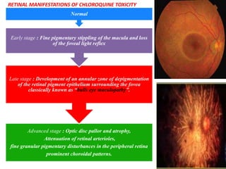 Chloroquine retinopathy | PPTX