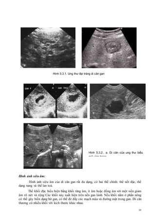 ultrasound images of liver tumor hình ảnh u gan trên siêu âm