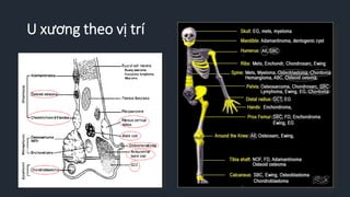 Chẩn đoán XQuang u xương lành tính | PPTX