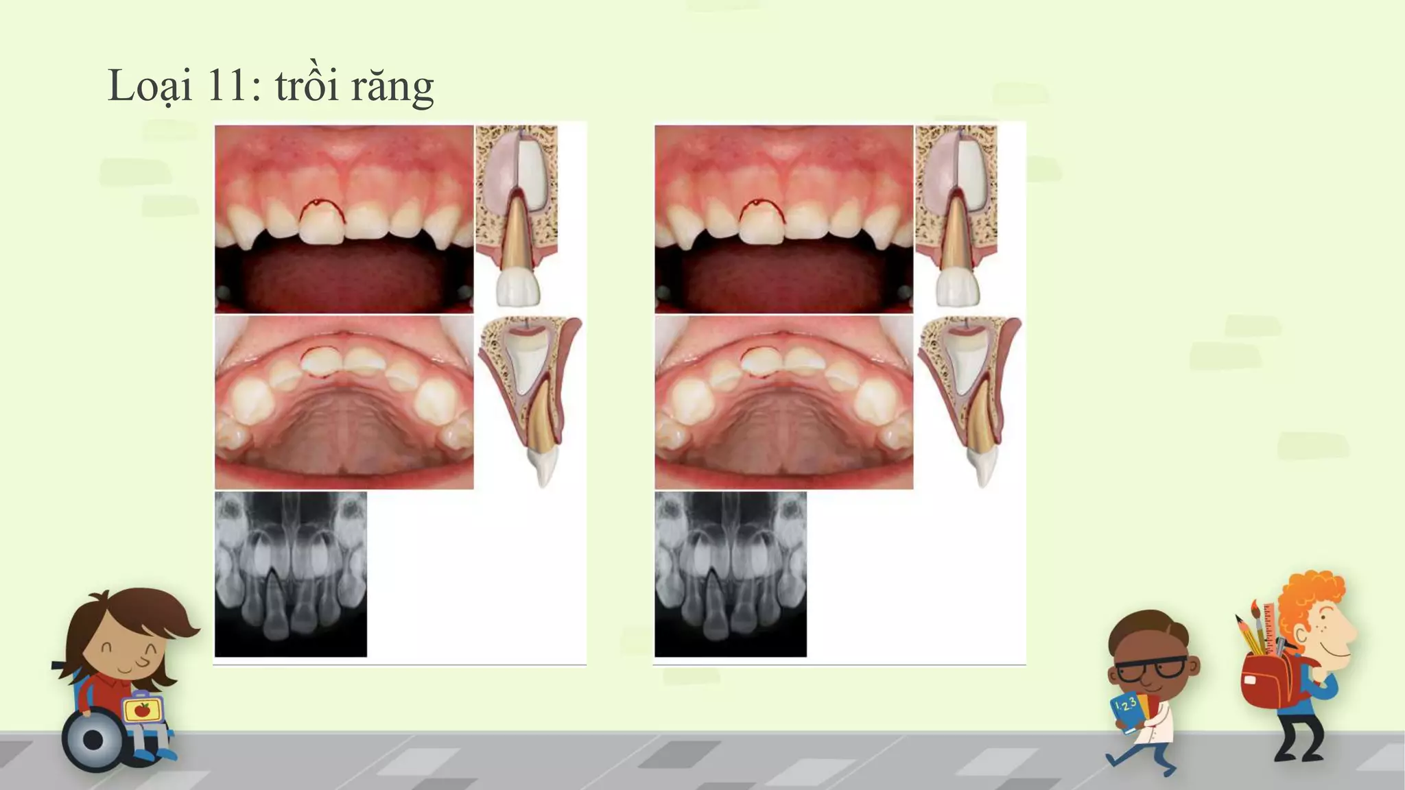 Chấn thương răng trẻ em | PPTX