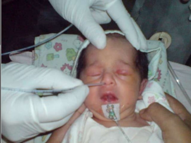 Choanal atresia in children | PPTX | Ear, Nose and Throat Conditions ...