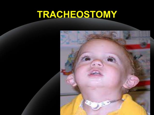 Choanal atresia in children | PPTX | Ear, Nose and Throat Conditions ...