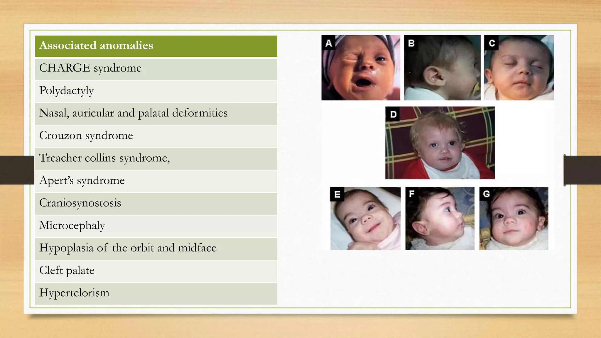 Choanal atresia | PPTX