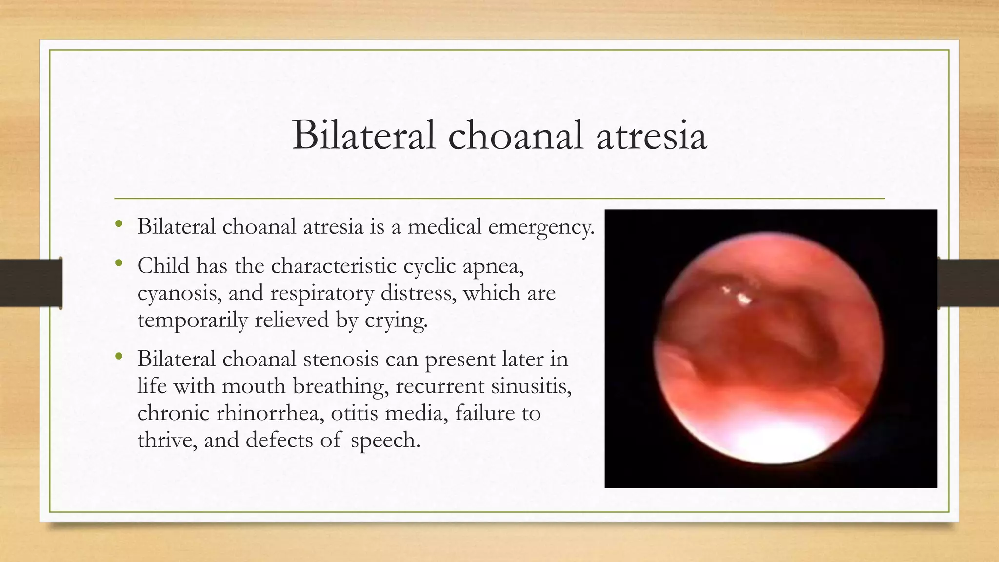 Choanal atresia | PPTX