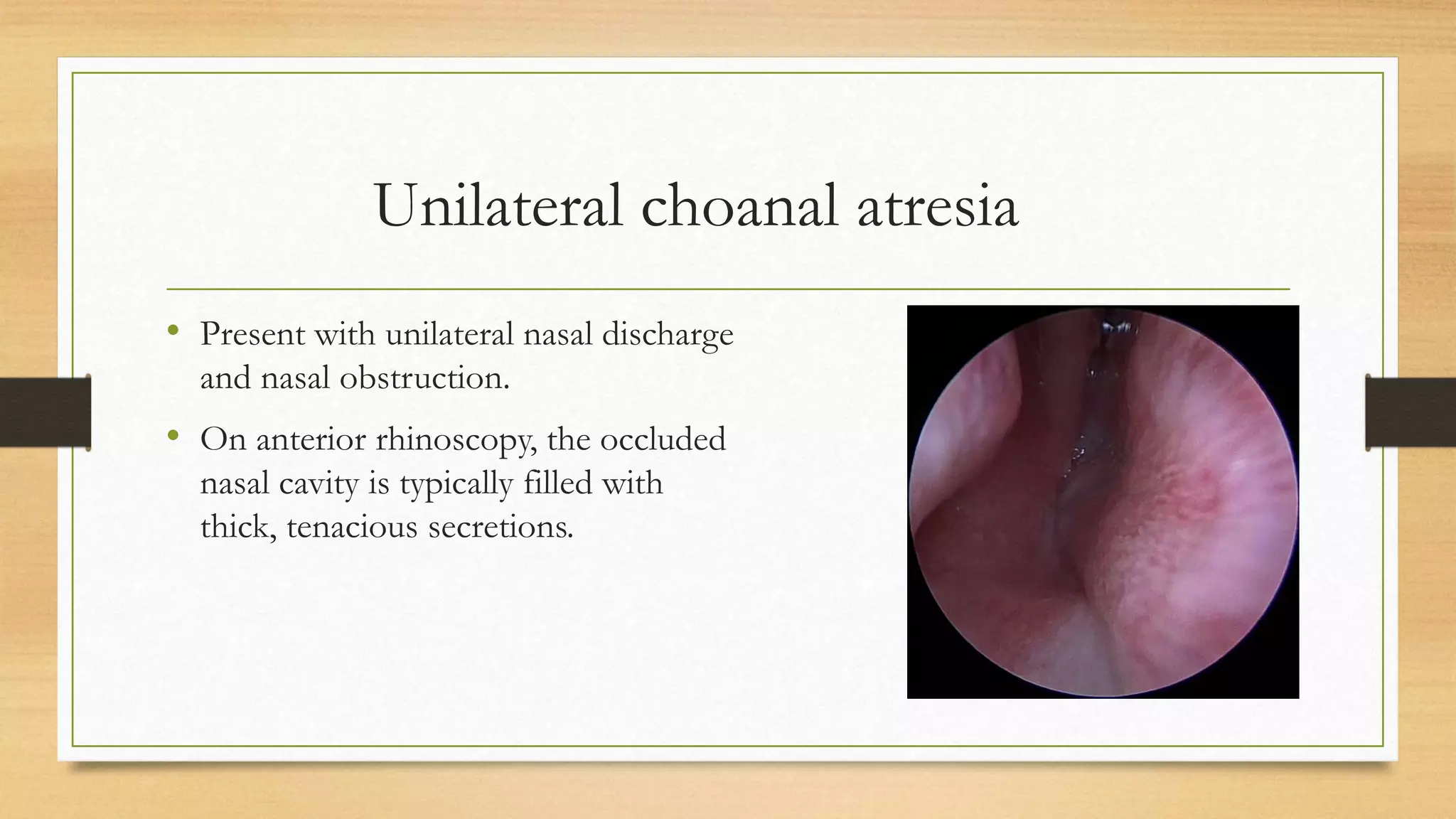 Choanal atresia | PPTX