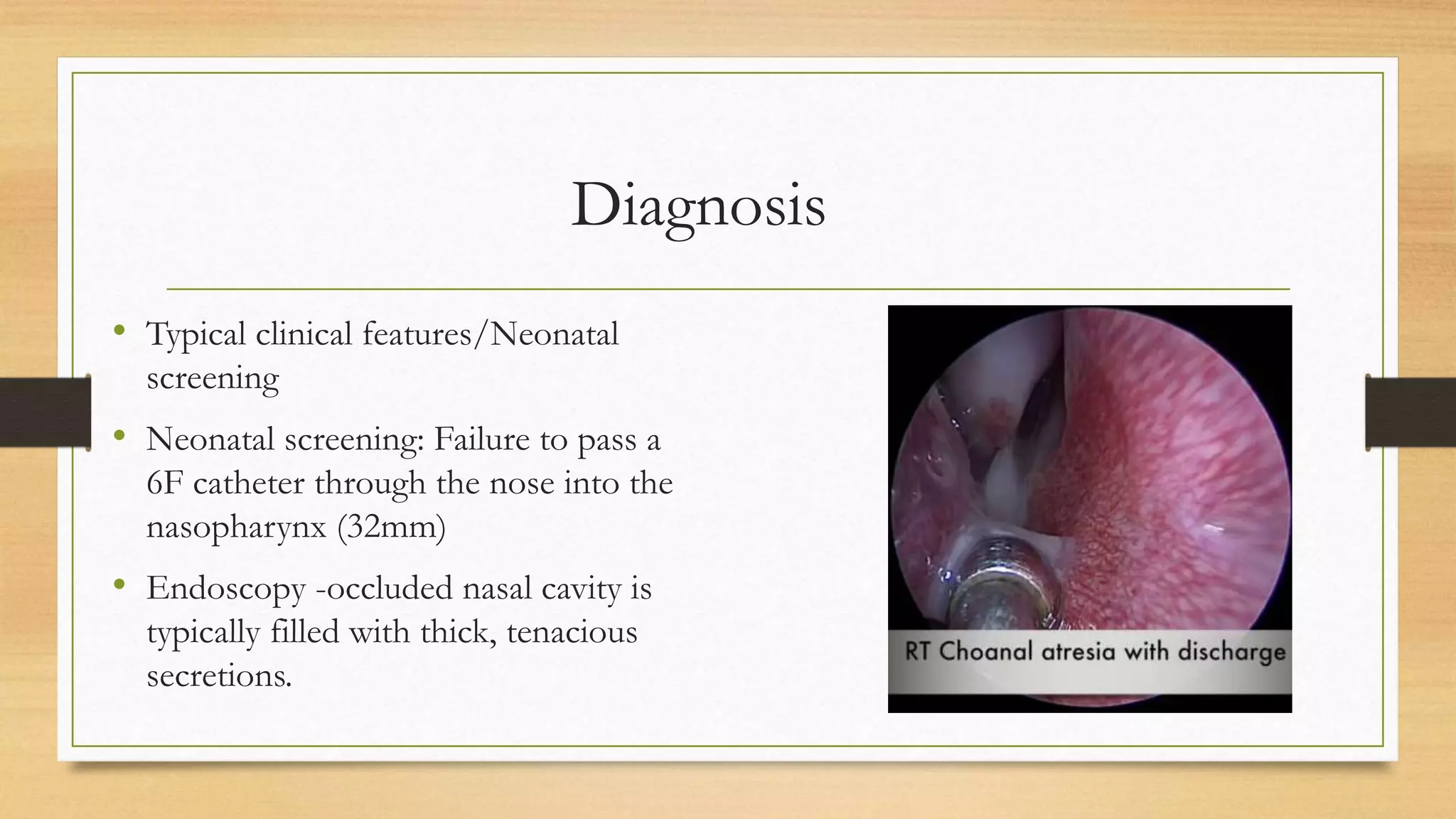Choanal atresia | PPTX