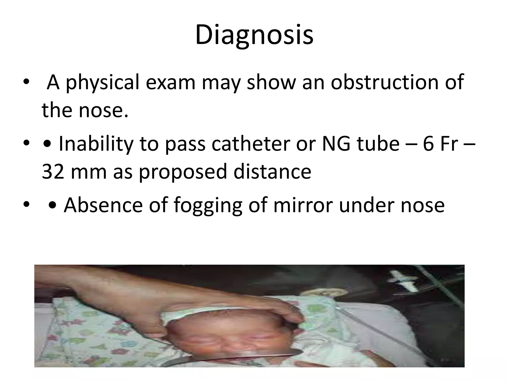 Choanal atresia | PPTX